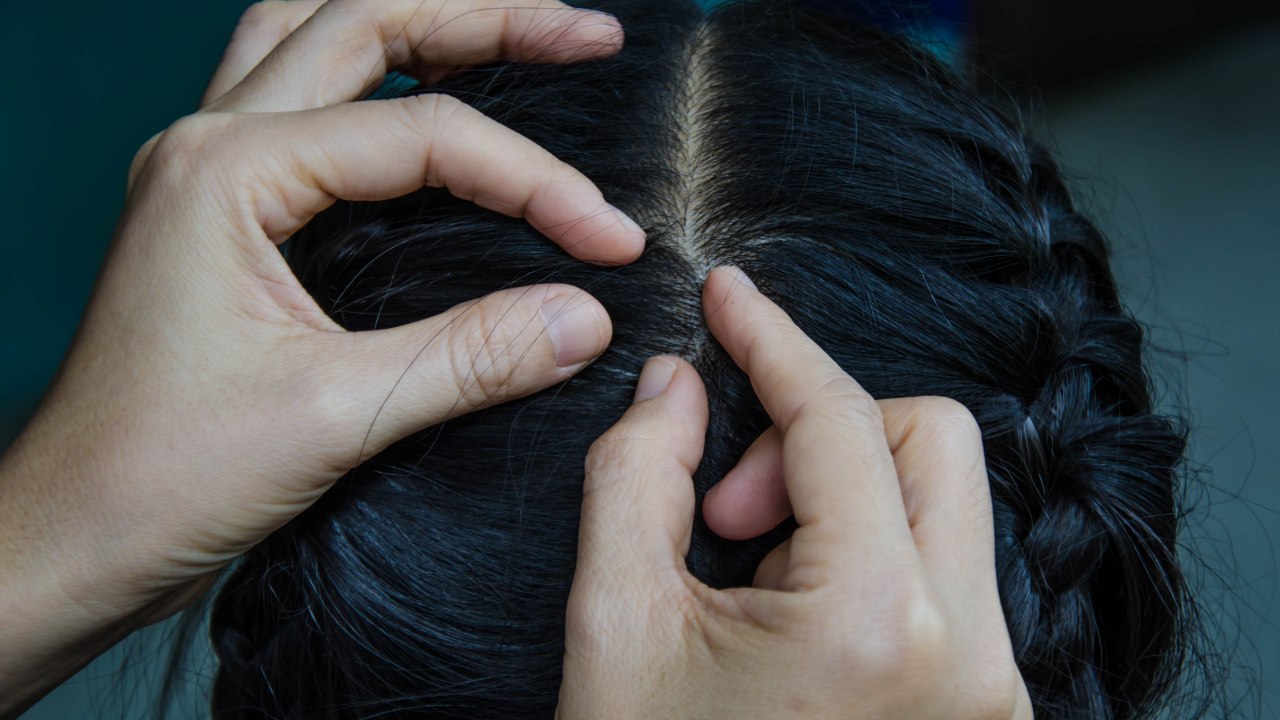 Kako se rešiti vaški? Najbolji načini